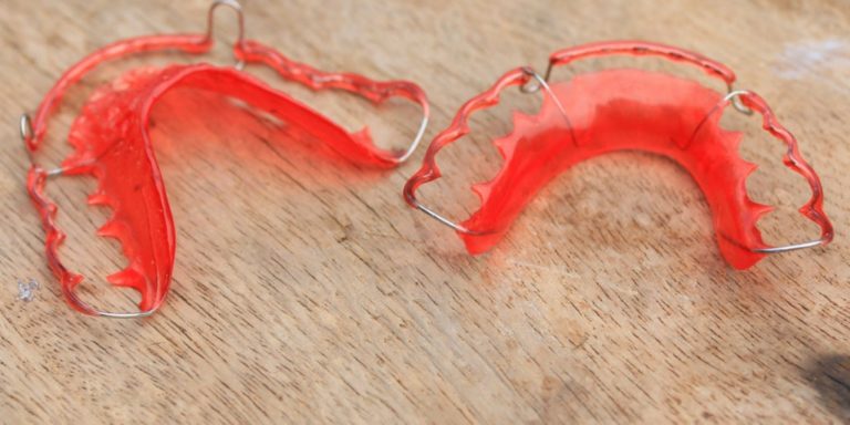 What are the Different Types of Retainers? - Schmitt Orthodontics