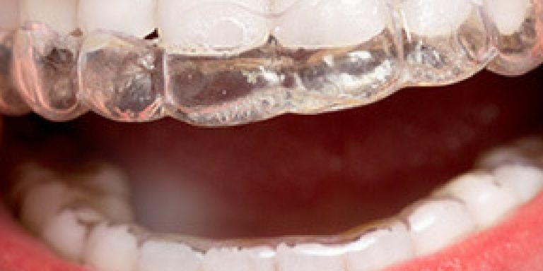 The 3 Basic Types of Retainers | Schmitt Orthodontics | Henderson, NC